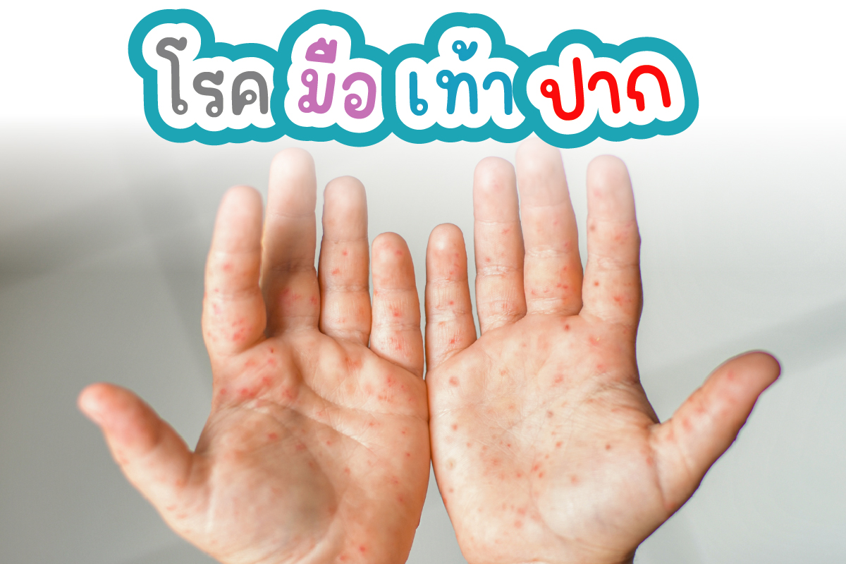 โรคมือ เท้า ปาก ในเด็กช่วงหน้าฝน